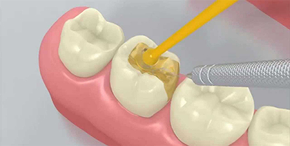 Incrustaciones - Clinica Dental Hervas